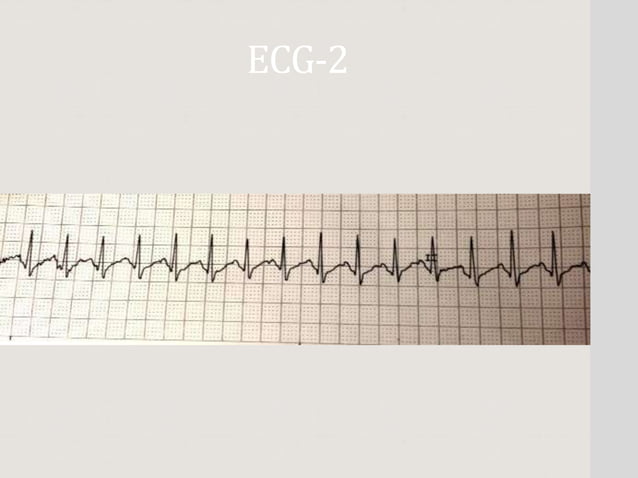 basic ECG SAMPLE WAY | PPTX | Heart and Cardiovascular Diseases ...