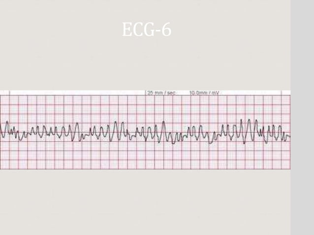 basic ECG SAMPLE WAY | PPTX | Heart and Cardiovascular Diseases ...