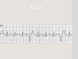 basic ECG SAMPLE WAY | PPTX