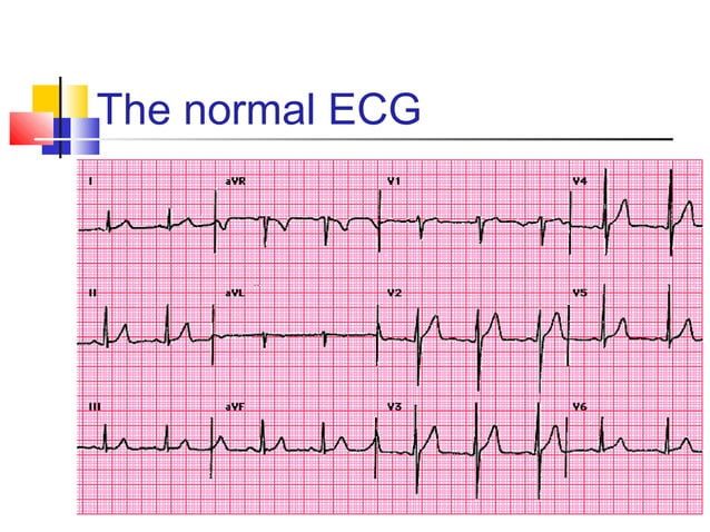 ECG Interpretation | PPT