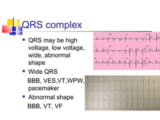 ECG Interpretation | PPT