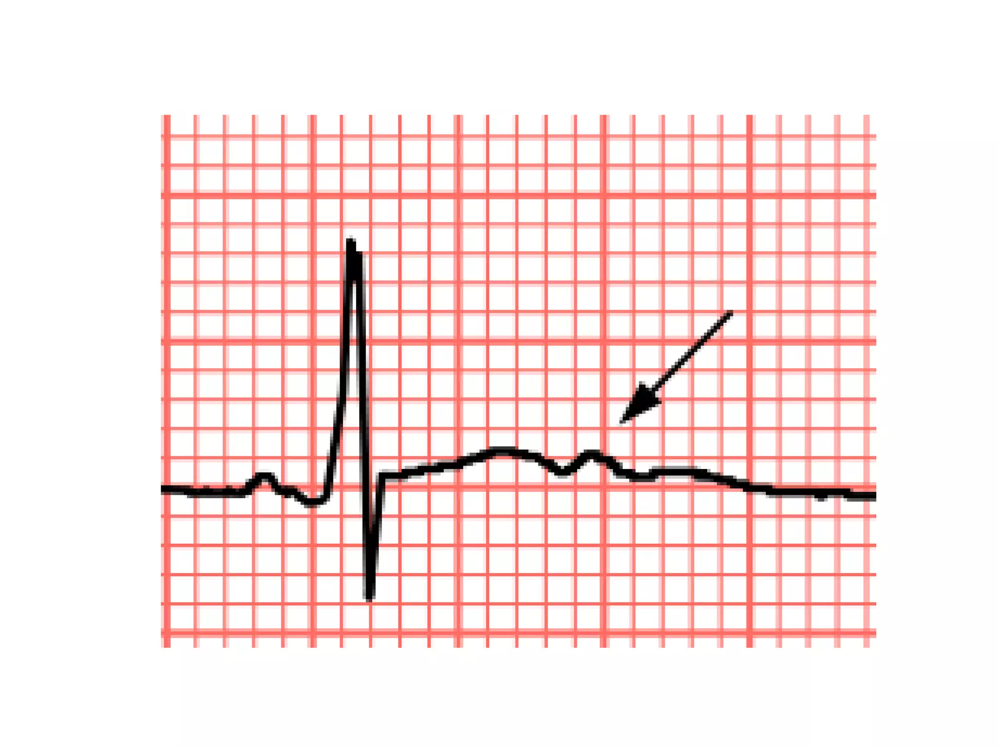 Ecg & electrolytes disturbance | PPTX