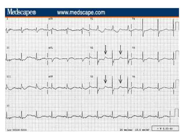 Ecg & electrolytes disturbance | PPTX | Heart and Cardiovascular ...
