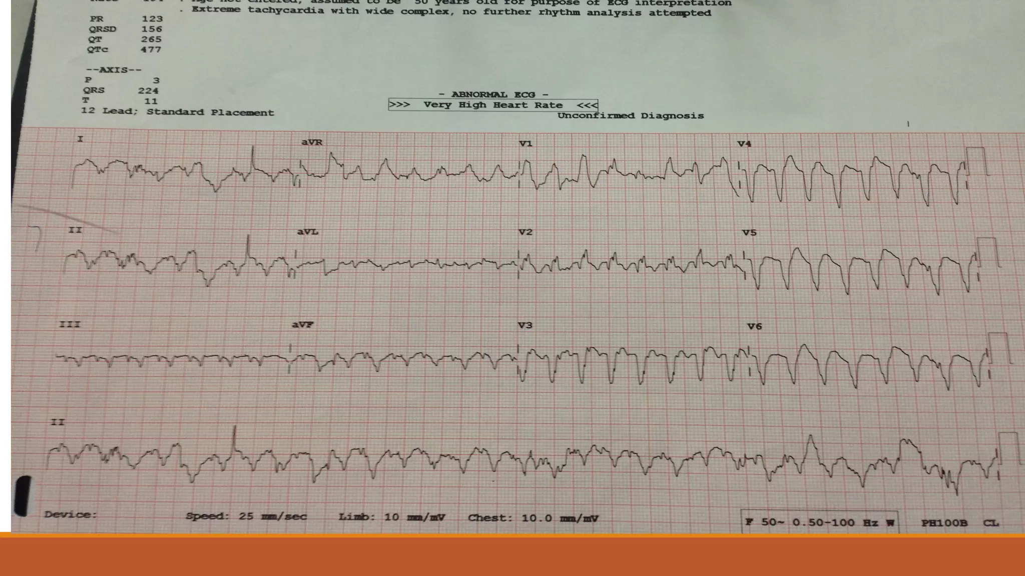 ECG emergencies | PPT