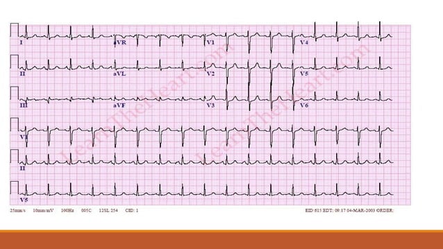 ECG emergencies | PPT