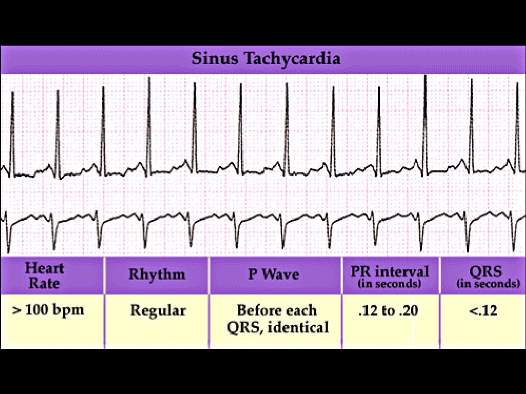Ecg En Arritmias