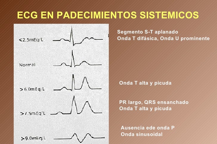 Ecg en Cardiopatías Congénitas
