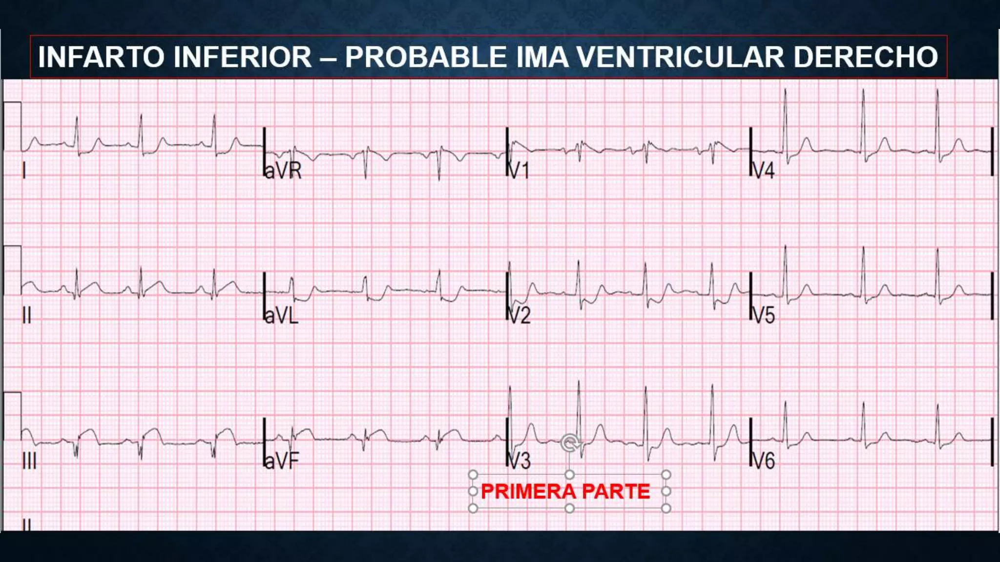 ECG EN INFARTO AGUDO DE MIOCARDIO URP 2022.pptx | Heart and ...