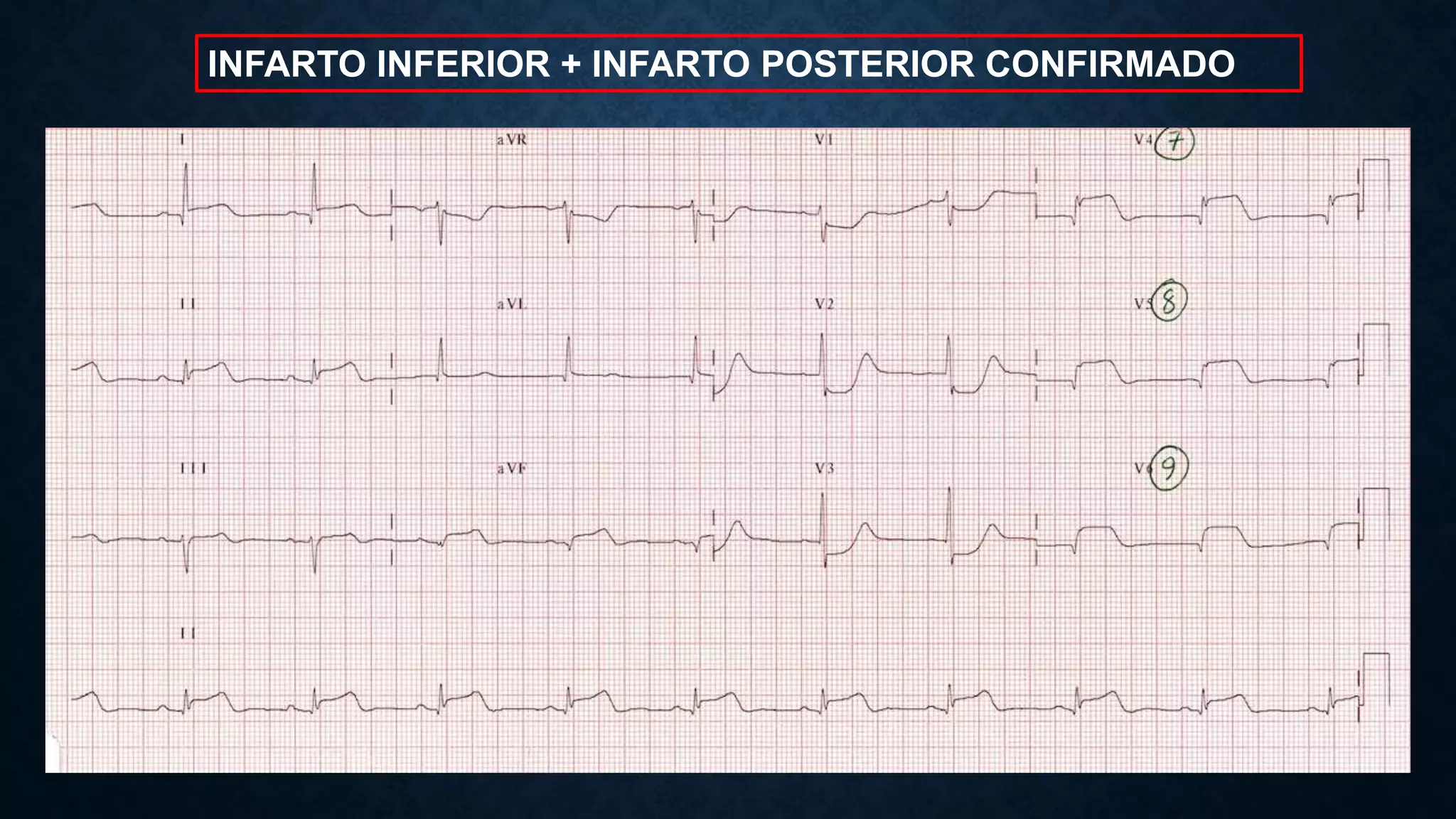 ECG EN INFARTO AGUDO DE MIOCARDIO URP 2022.pptx | Heart and ...