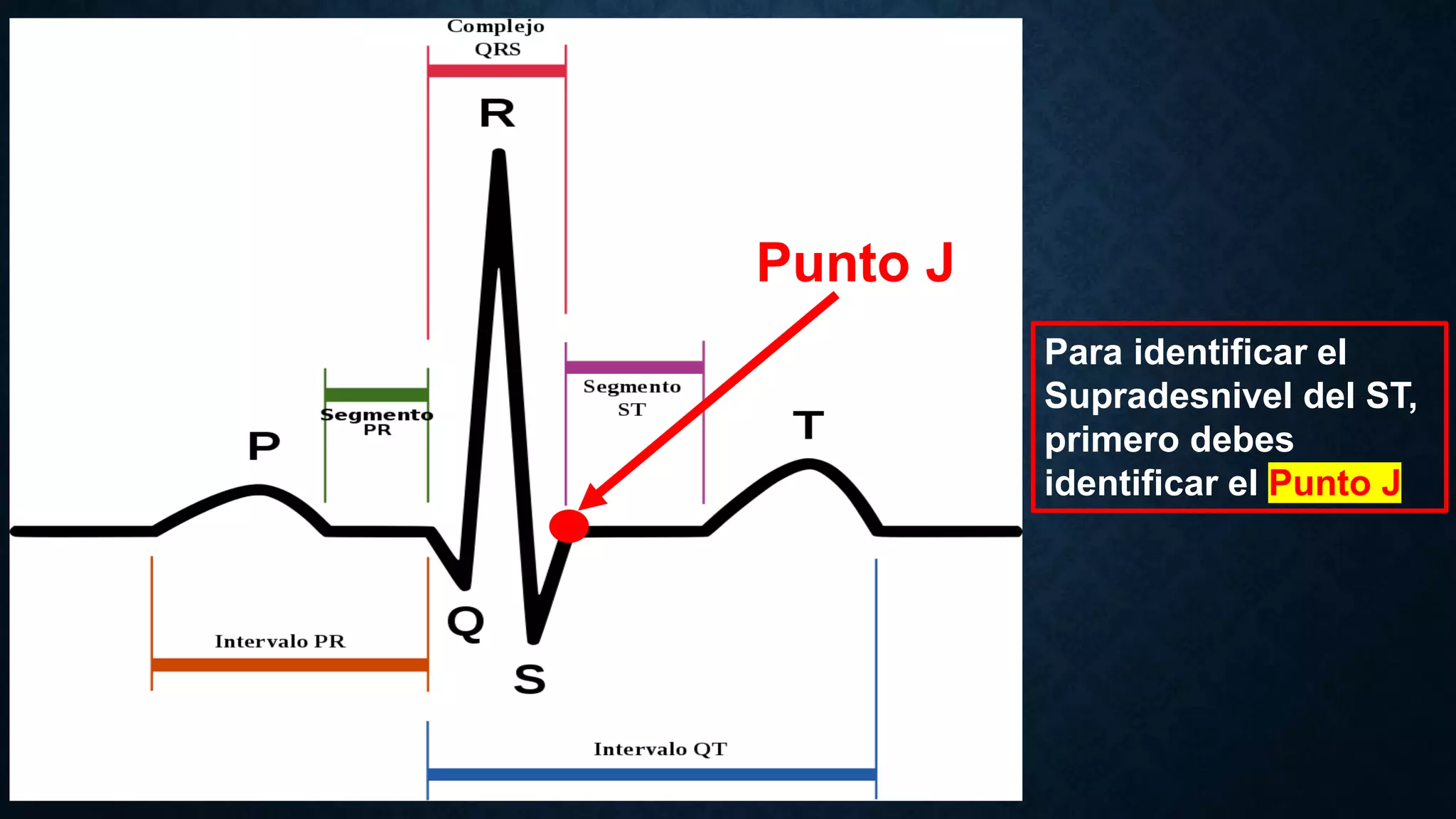 ECG EN INFARTO AGUDO DE MIOCARDIO URP 2022.pptx | Heart and ...