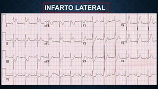 ECG EN INFARTO AGUDO DE MIOCARDIO URP 2022.pptx