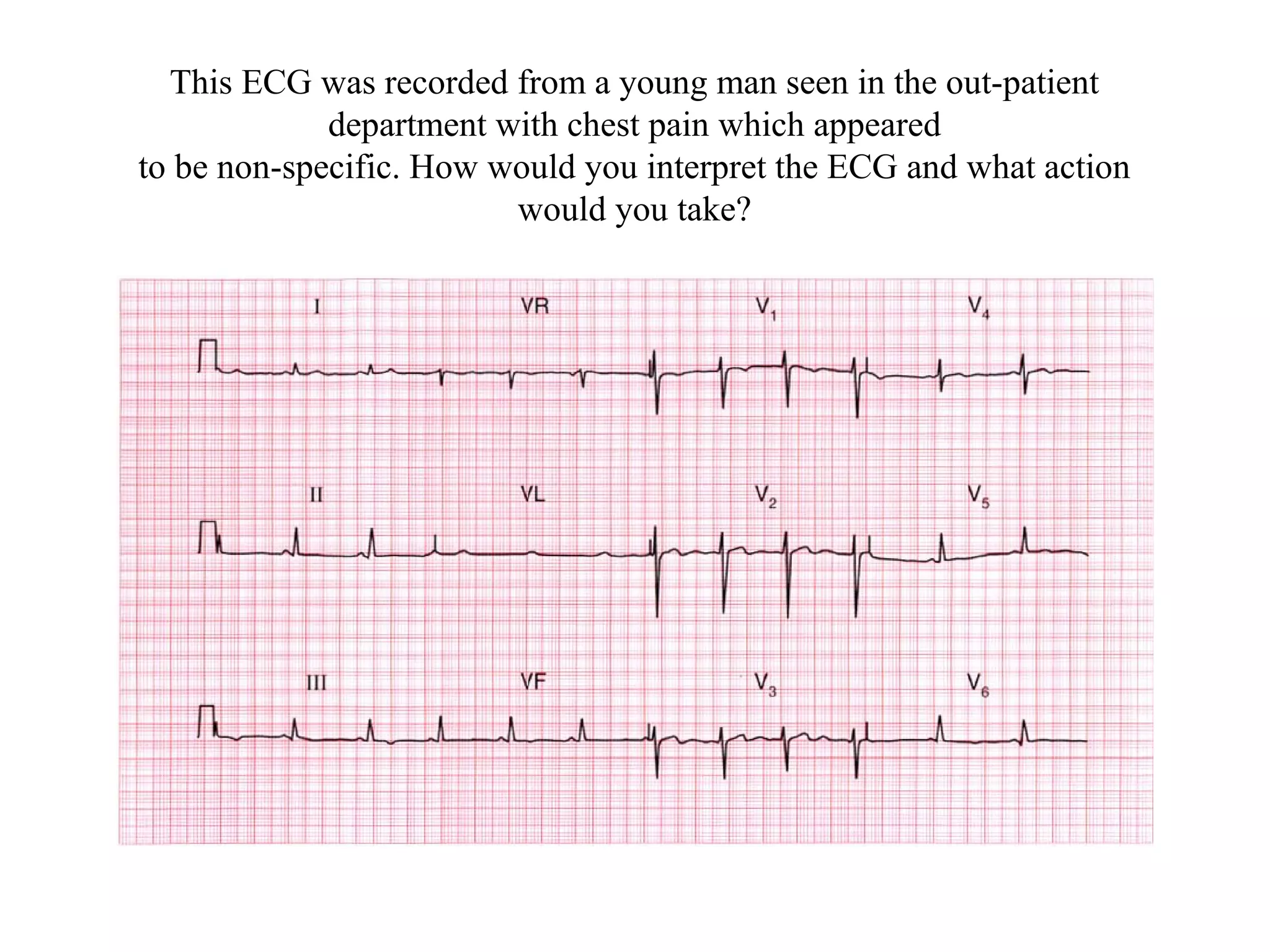 ECG evaluation | PPT