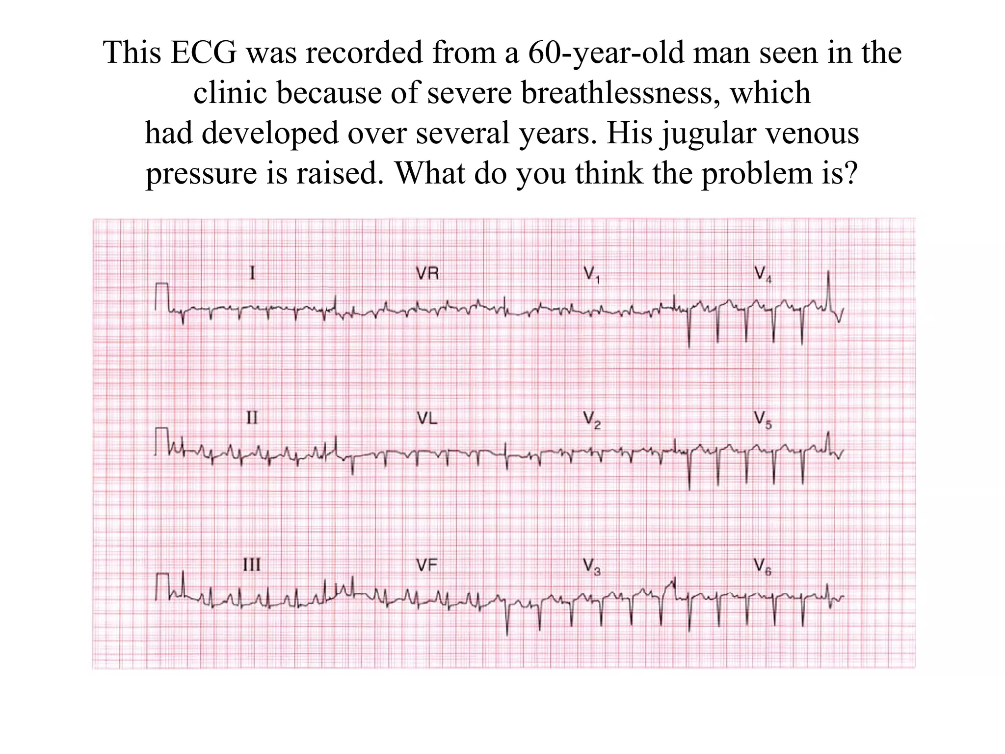 ECG evaluation | PPT