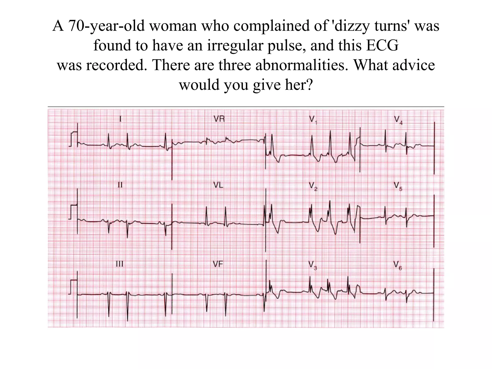 ECG evaluation | PPT
