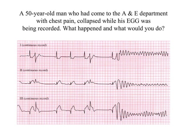 ECG evaluation | PPT