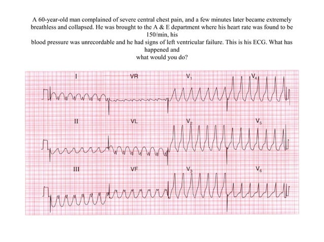 ECG evaluation | PPT