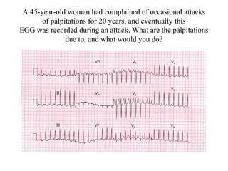 ECG evaluation | PPT
