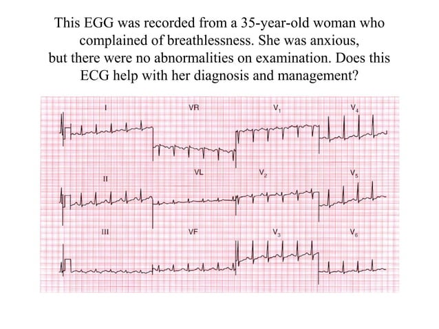 ECG evaluation | PPT