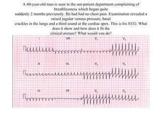 ECG evaluation | PPT