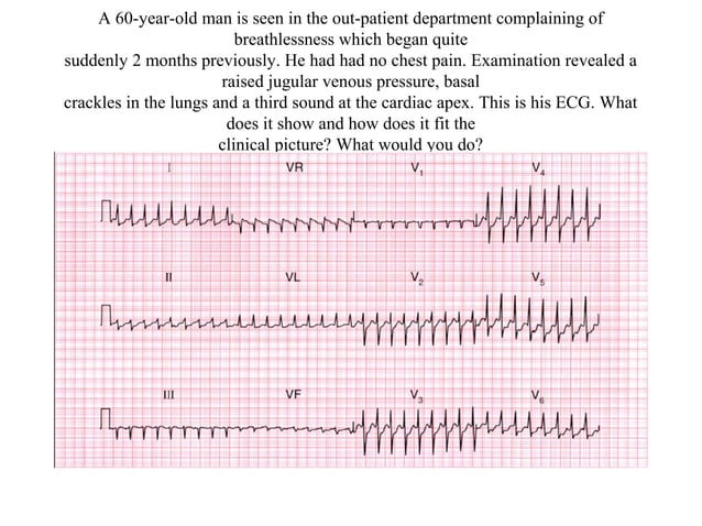 ECG evaluation | PPT