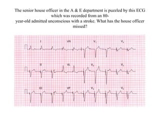 ECG evaluation | PPT