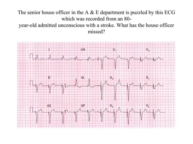 ECG evaluation | PPT