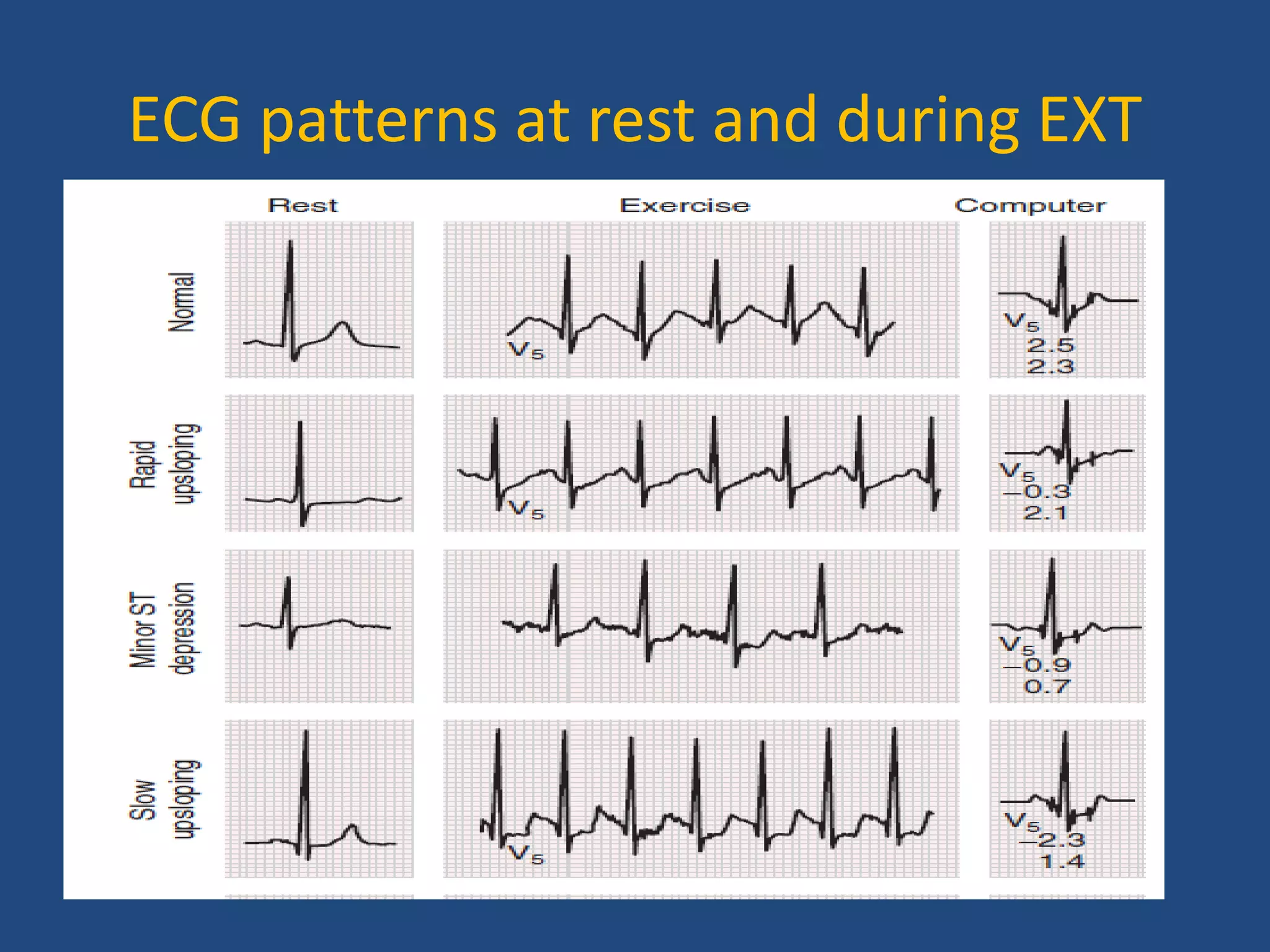 ECG Exercise Tolerance Test | PPTX