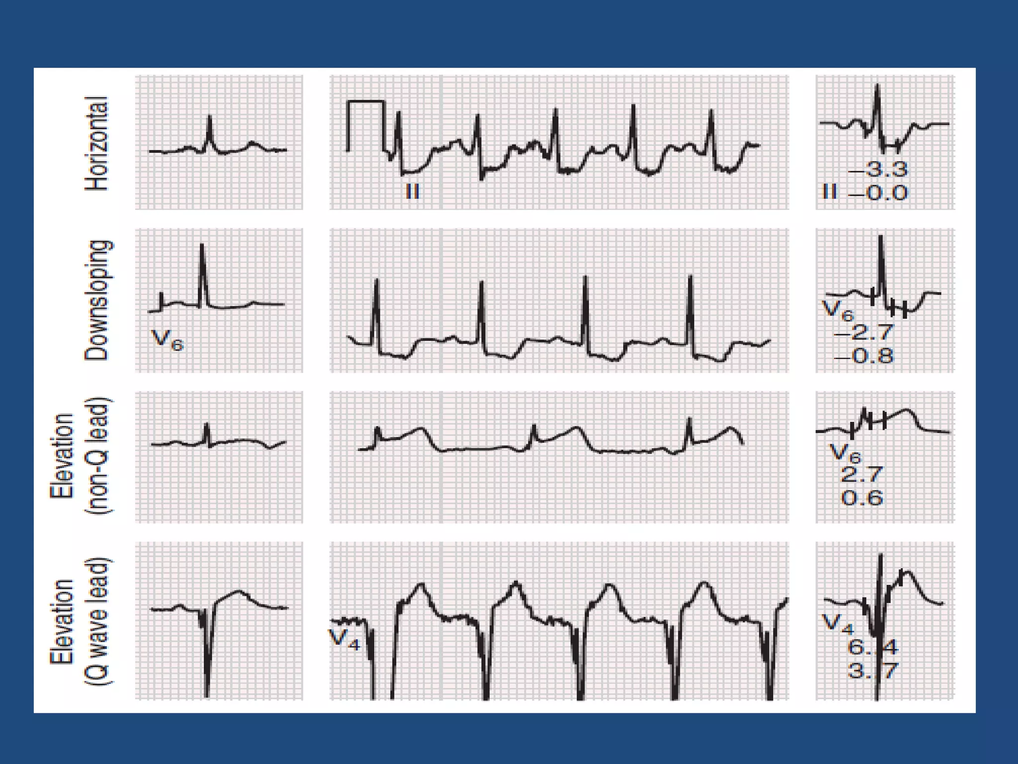 ECG Exercise Tolerance Test | PPTX