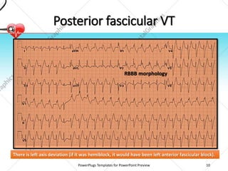 ECG F | PPT