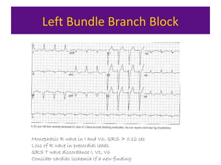 Ecg interpretation | PPT