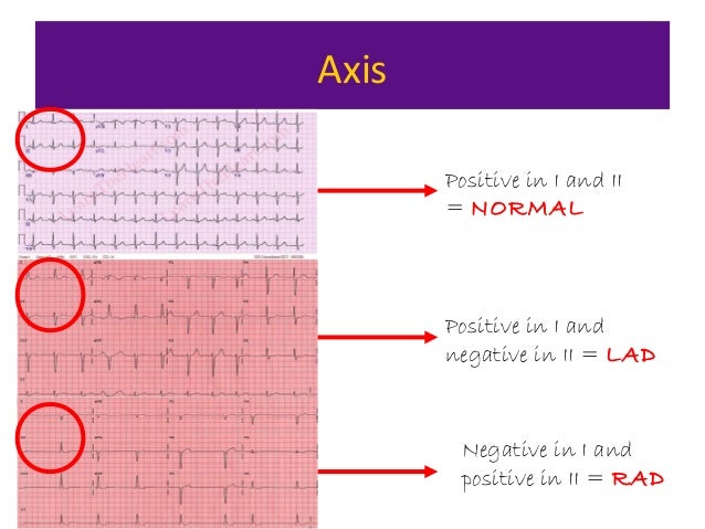 Ecg interpretation