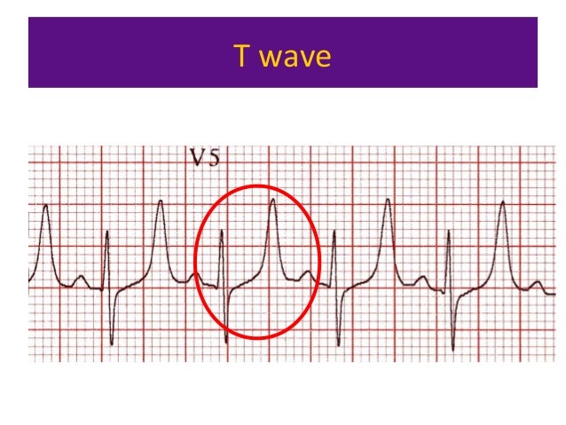 Ecg interpretation