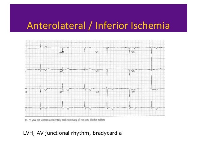 Ecg Interpretation