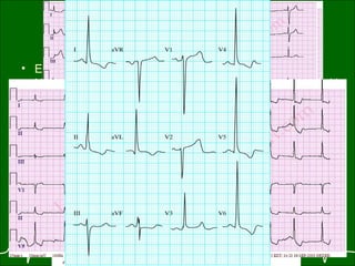 ECG Final Proff.Sumit Kr Ghosh Dept of Internal Medicine Medical ...