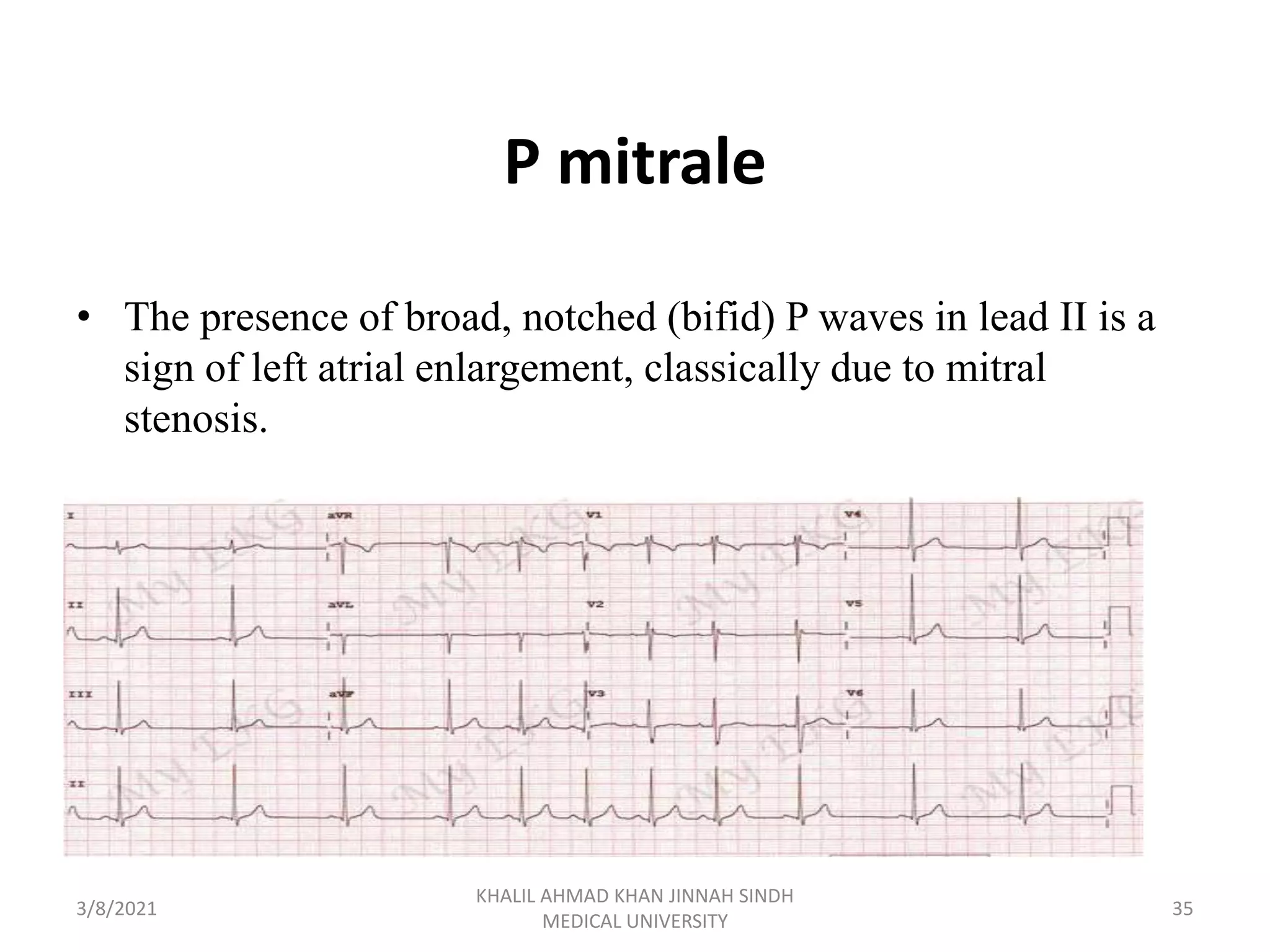 Basic of ECG with common abnormalities. | PPTX | Heart and ...