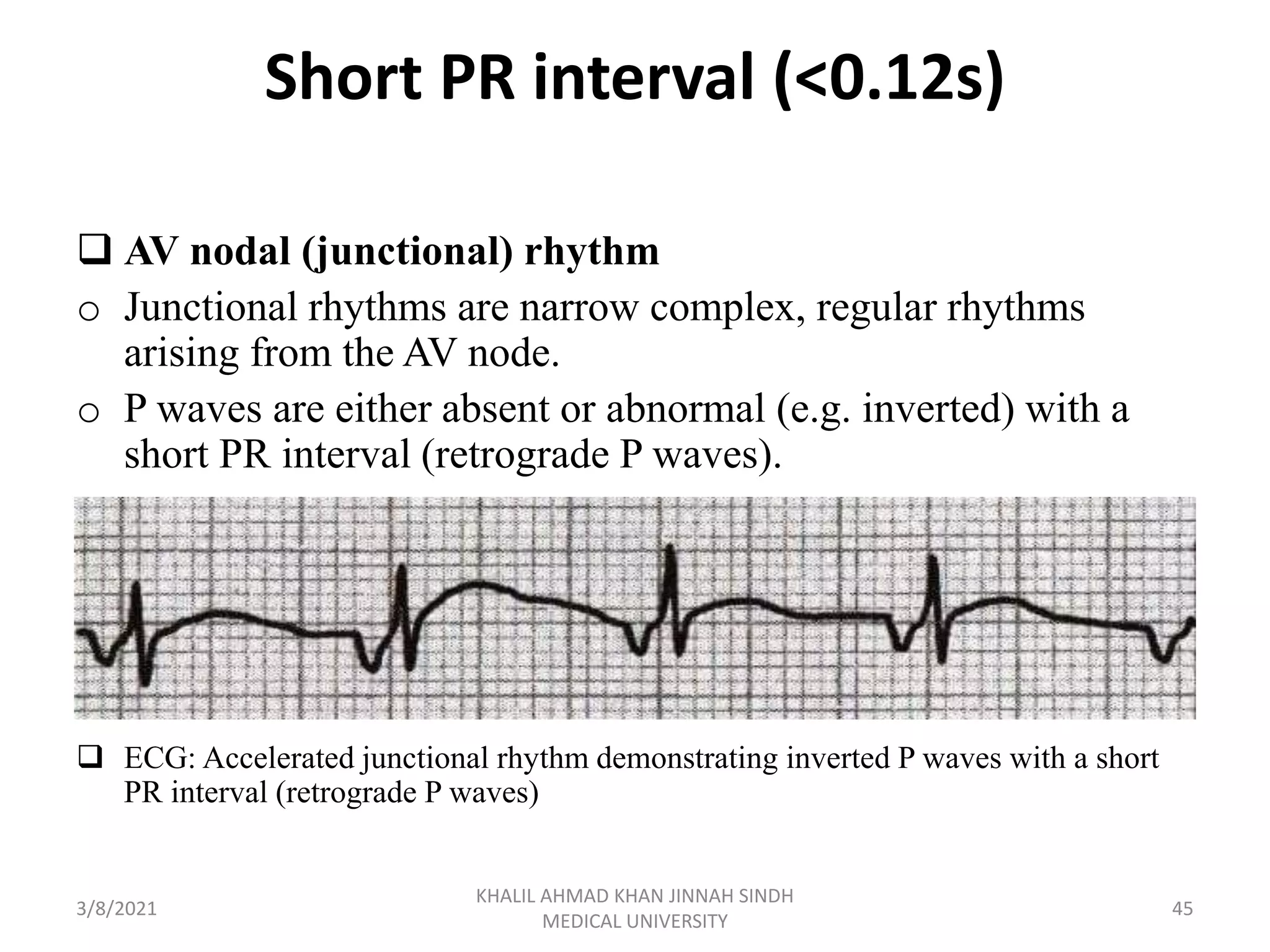 Basic of ECG with common abnormalities. | PPTX | Heart and ...
