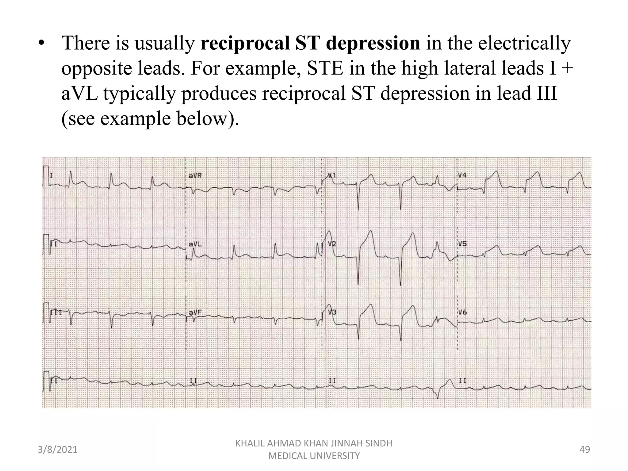 Basic of ECG with common abnormalities. | PPTX | Heart and ...
