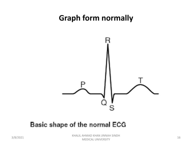 Basic of ECG with common abnormalities. | PPTX | Heart and ...