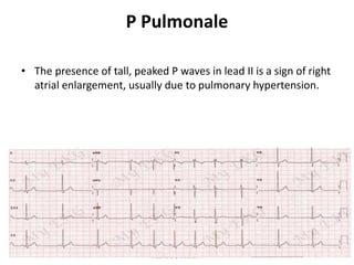 Basic of ECG with common abnormalities. | PPTX