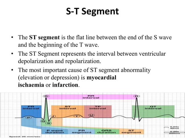 Basic of ECG with common abnormalities. | PPTX | Heart and ...