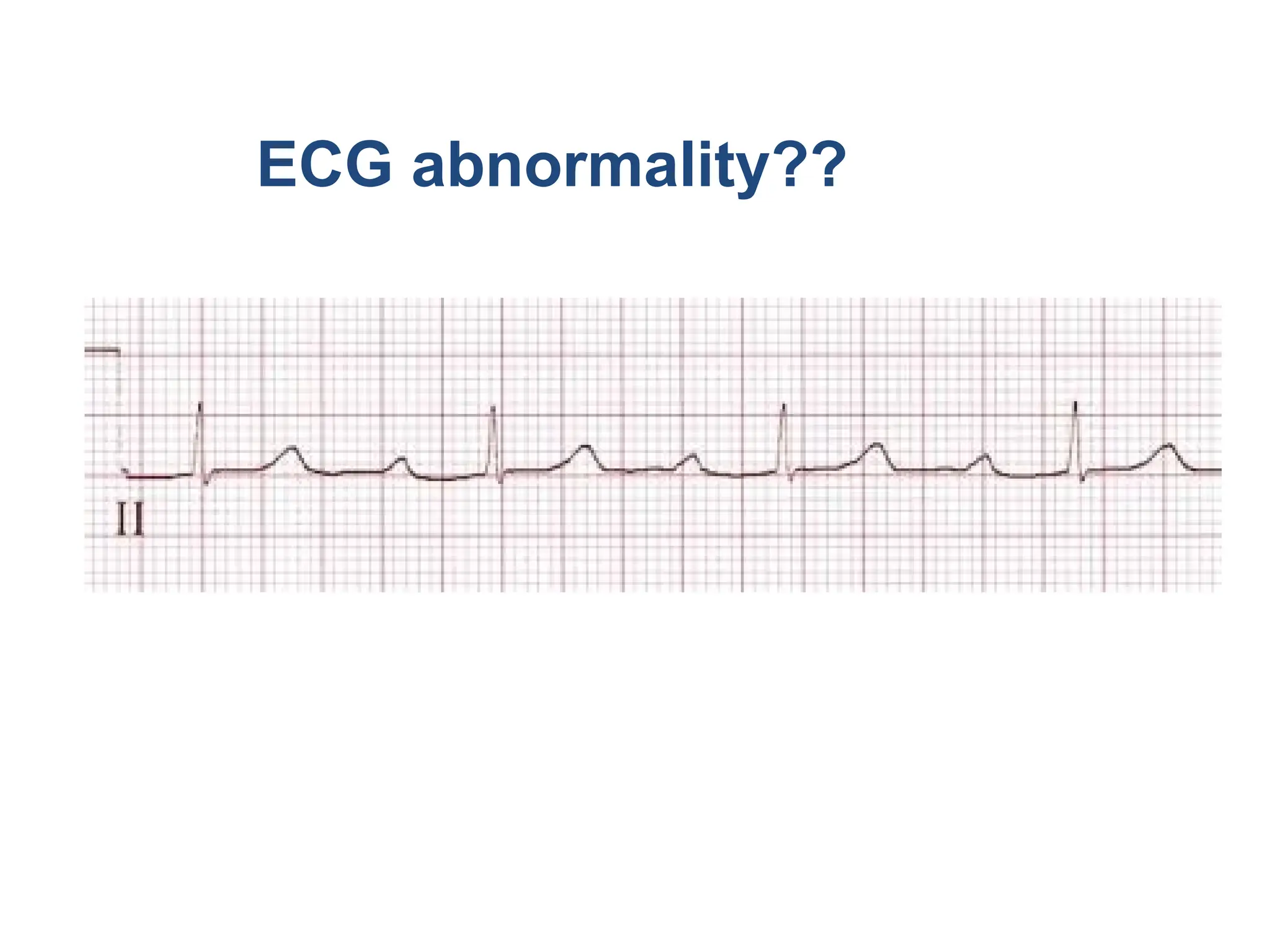 ECG final.pptx cardiology newborn very essential | PPT