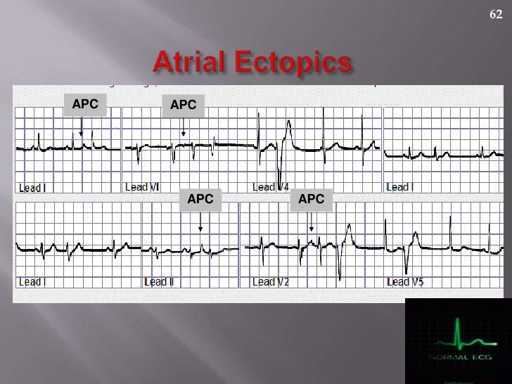 Ecg final pp ts; 19 06-2012