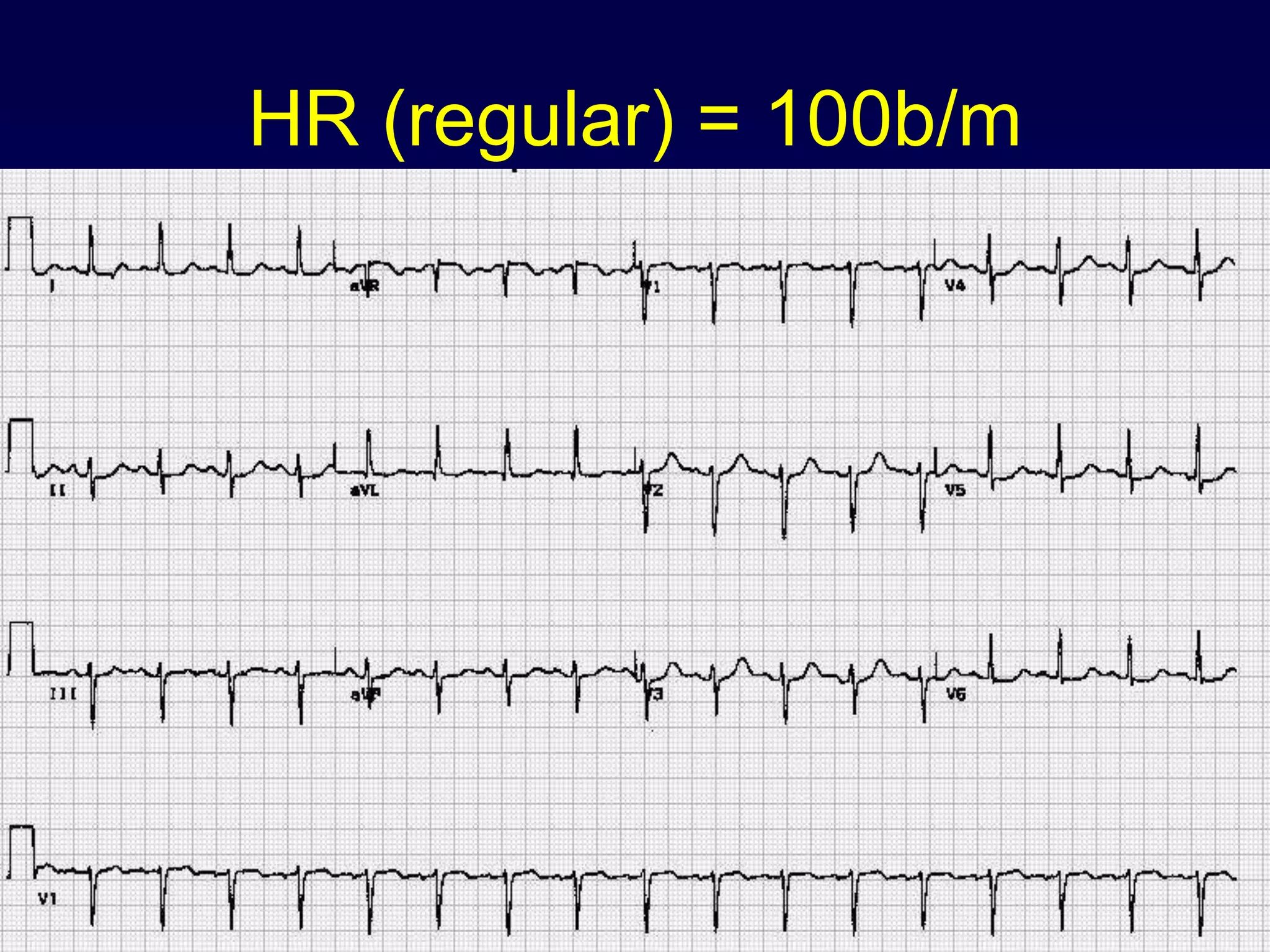 Ecg final the best | PPT