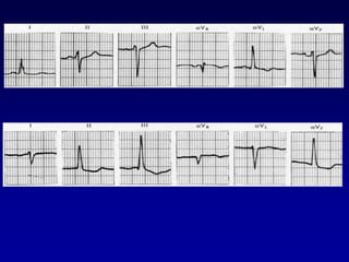 Ecg final the best | PPTX