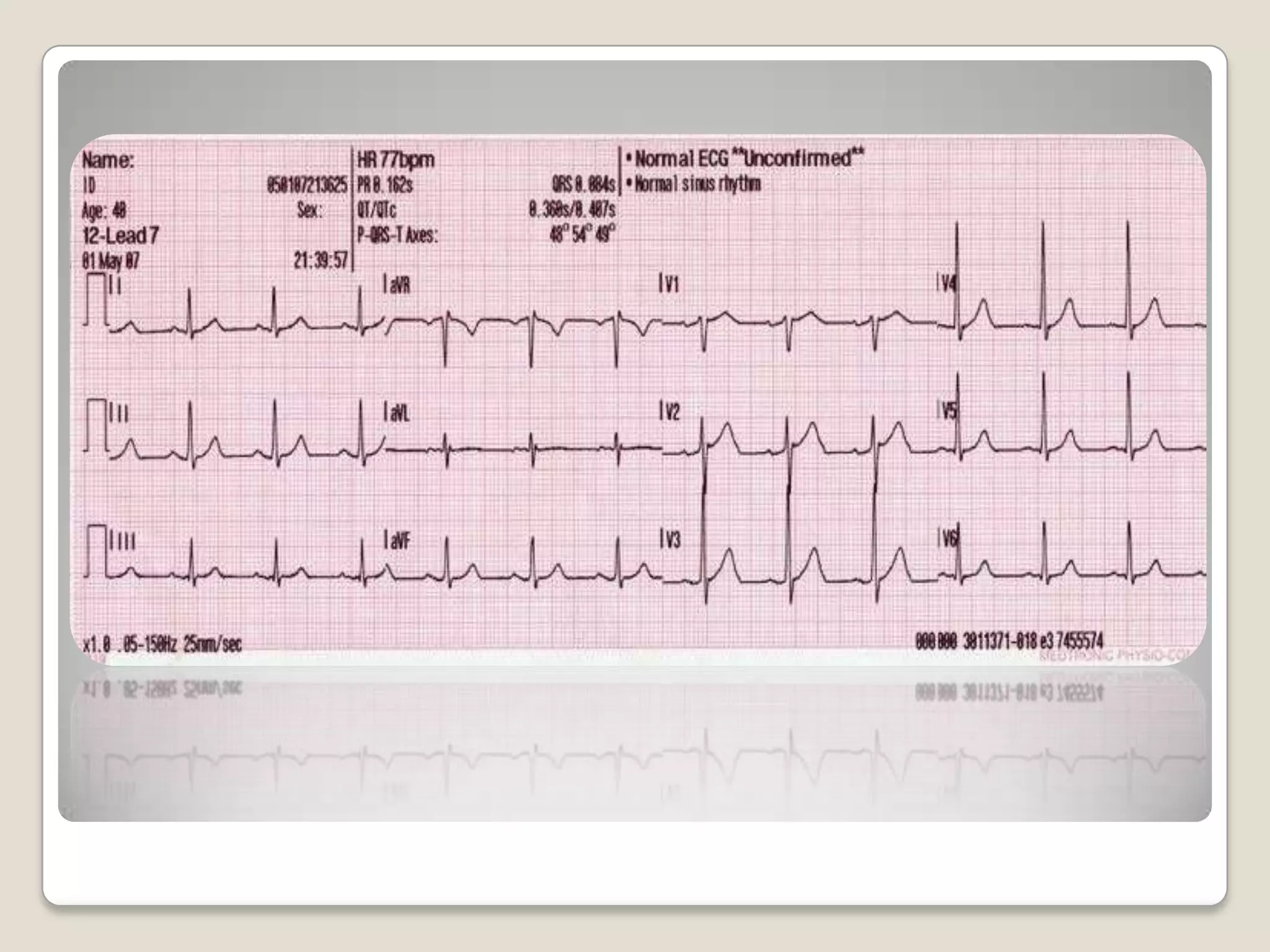 Ecg findings in life threatening conditions | PPTX