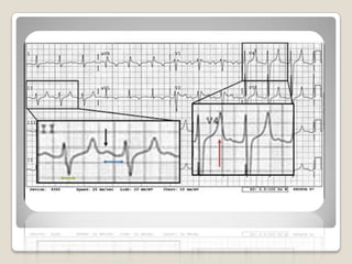 Ecg findings in life threatening conditions | PPTX
