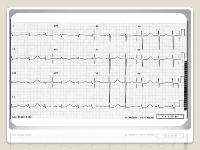 Ecg findings in life threatening conditions | PPTX