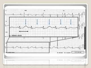 Ecg findings in life threatening conditions | PPTX