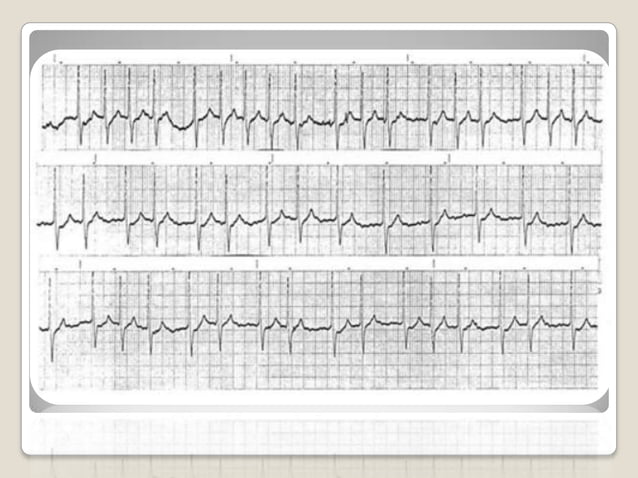 Ecg findings in life threatening conditions | PPTX