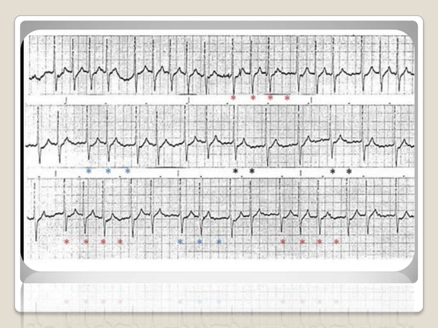 Ecg findings in life threatening conditions | PPTX